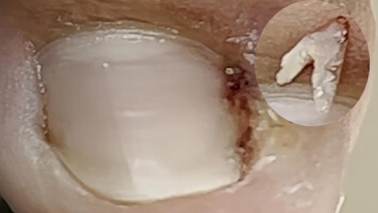 La fuente de la inflamación del dedo del pie es una uña encarnada ...