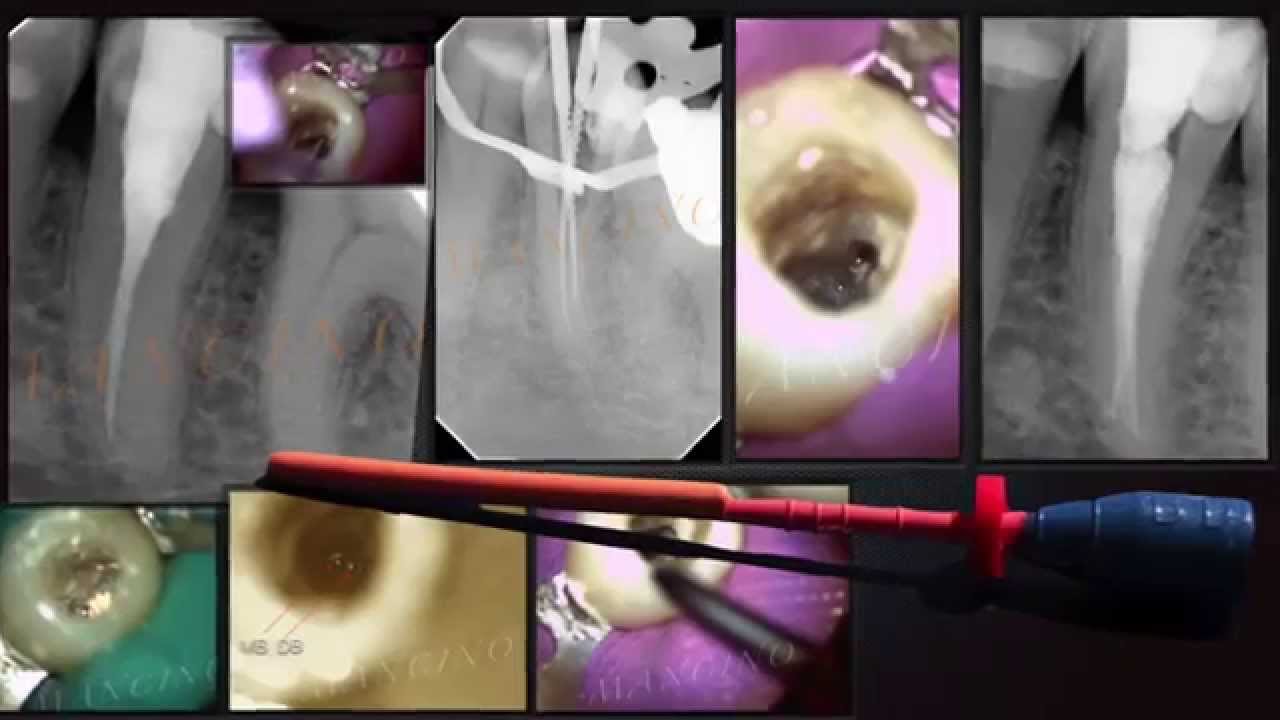 minimally invasive endodontics - YouTube