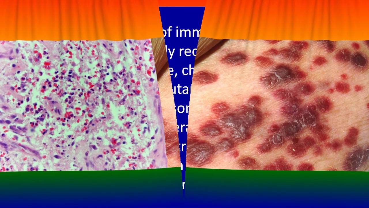 Bacillary Angiomatosis - YouTube