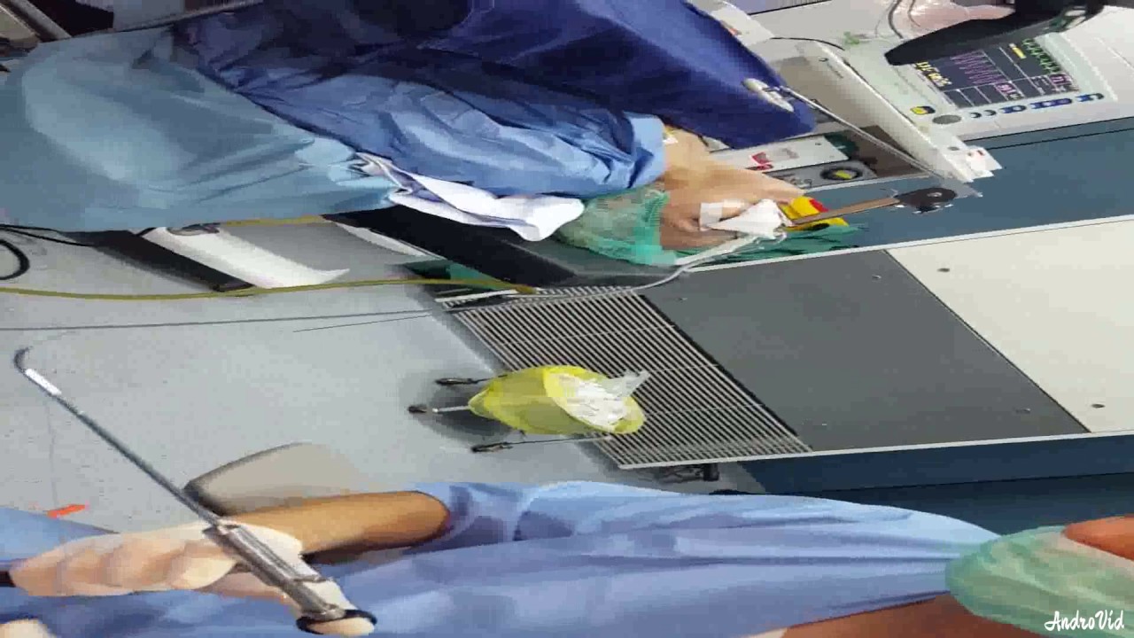 Interposition pour synechie de la commissure ant avec la technique de ...