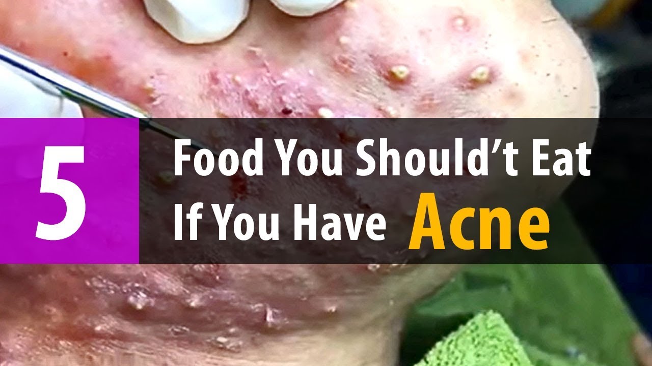 5 Food You Shouldn't Eat If You Want Have Acne ON Face Dr Laelia - YouTube