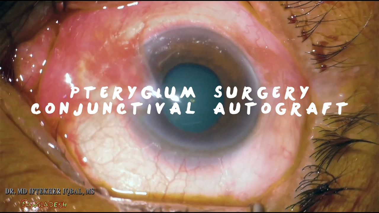 miiq-97-pterygium-surgery-conjunctival-autograft-with-sutures-dr