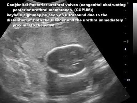 CASE 545 Congenital Posterior urethral valves PUV keyhole sign - YouTube