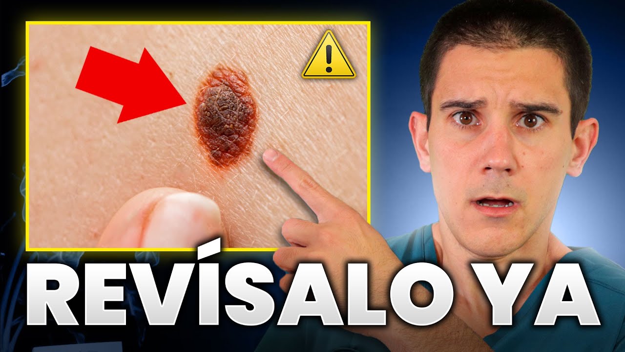 ¡PELIGRO!👉Dermatólogo te explica qué hacer con un LUNAR RARO en tu PIEL ...