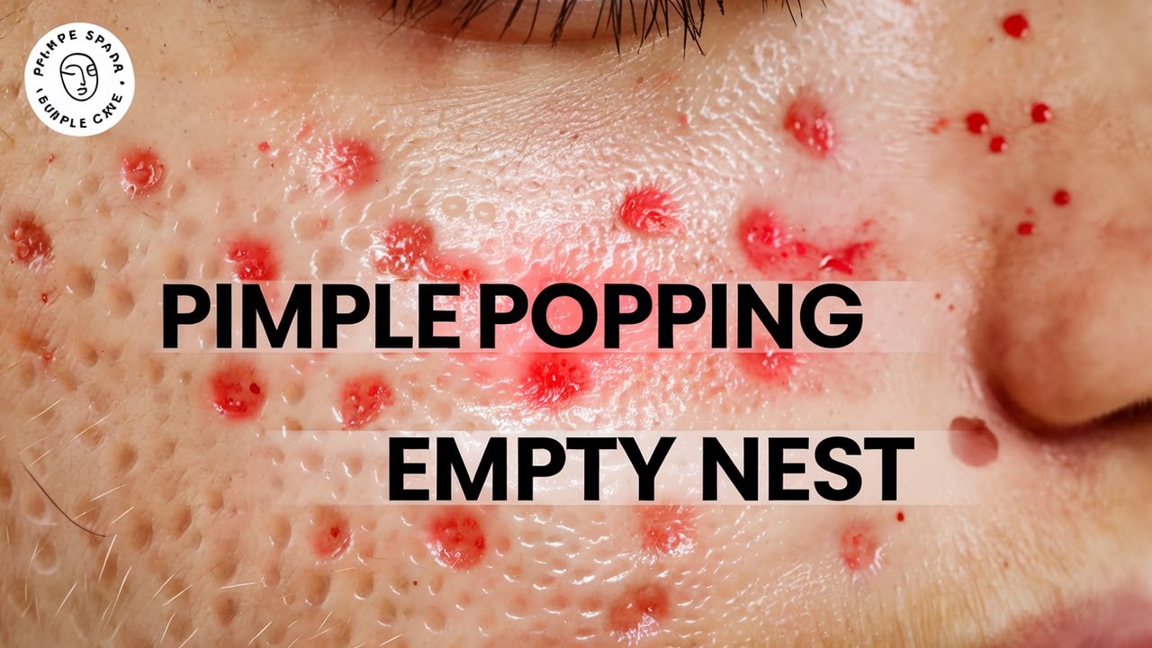 Blackhead Removal Empty Nest Part112|PIMPLE SPA - YouTube