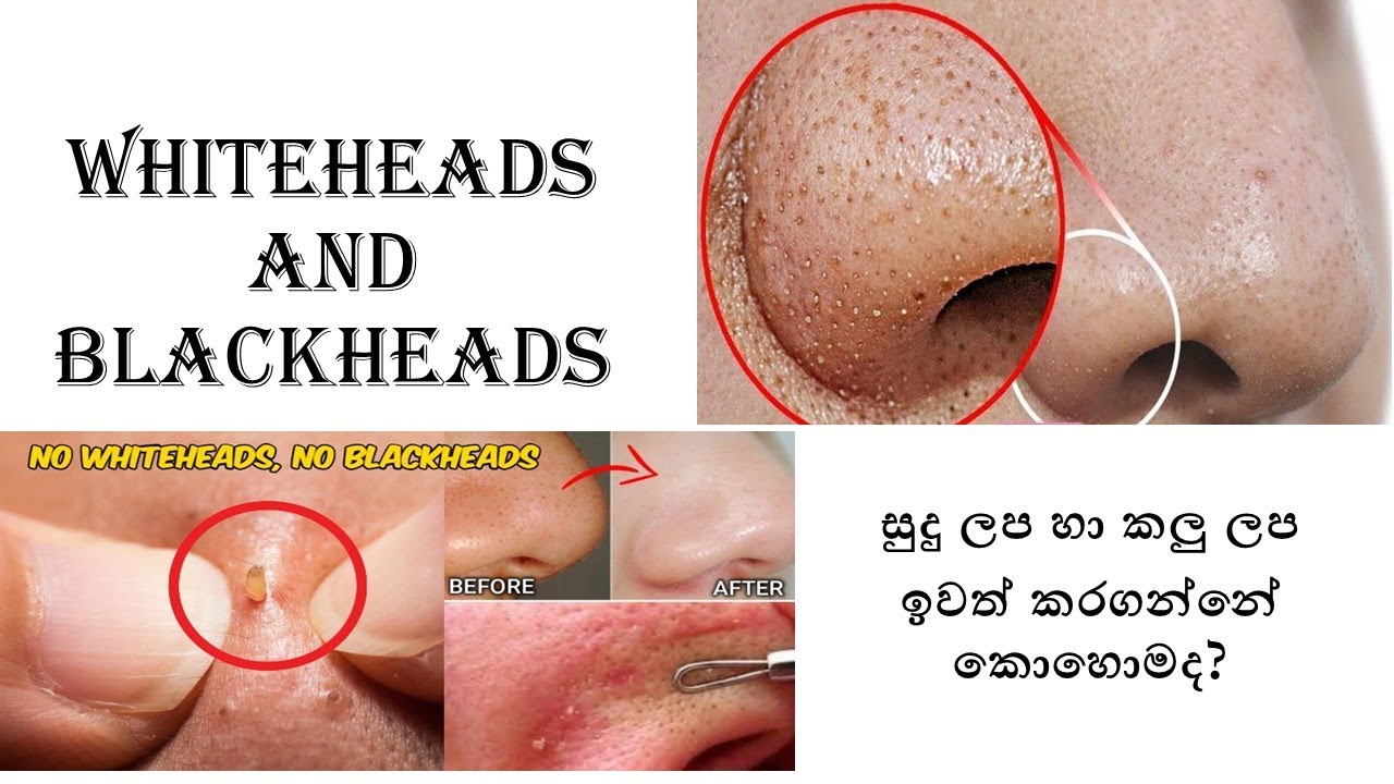 සුදු ලප හා කලු ලප ඉවත් කරගන්නේ කොහොමද? how to remove whiteheads and blackheads on your face ...