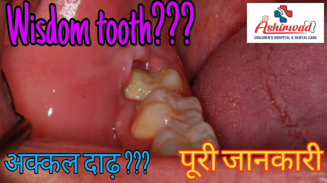 wisdom tooth | अक्कल दाढ़ | know everything in detail | pain, redness ...