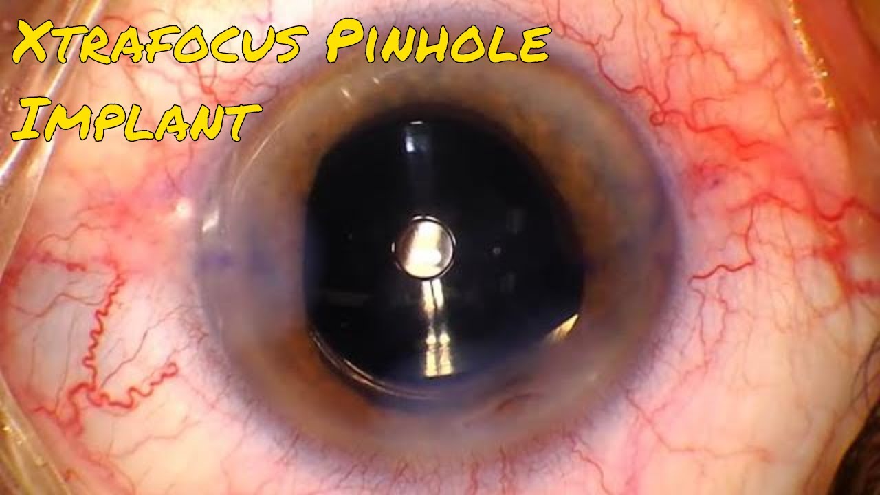 Phacoemulsification with Xtrafocus pinhole implant for cataract surgery ...