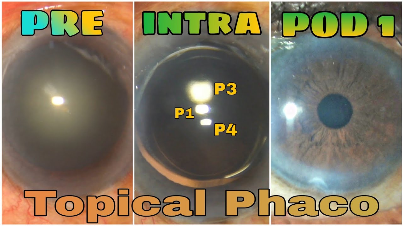 #51 Topical Phaco : Alcon Legion : one of my early experience # ...