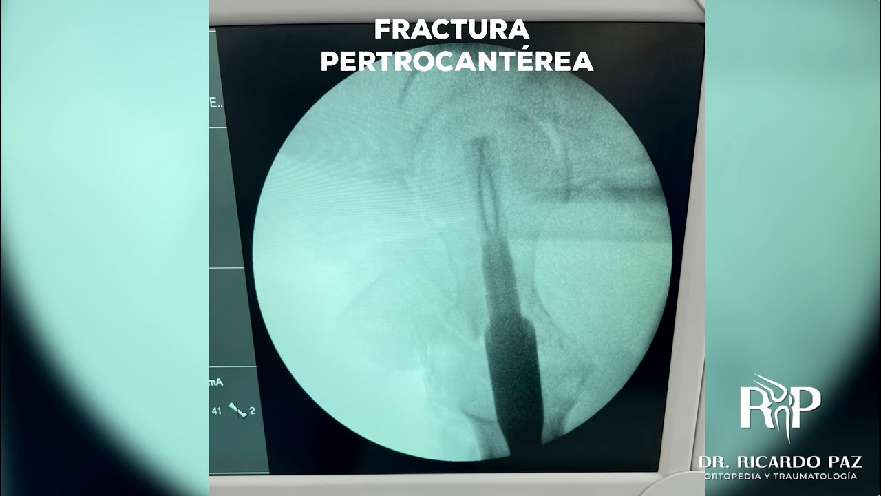 Fractura Pertrocantérea en Cadera #casoclínico #cadera - YouTube