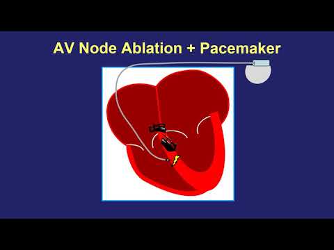 Patient education video titled: 'A.fib How Do We Treat It' narratedV2 ...
