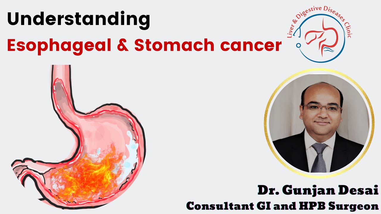 What causes esophageal or food pipe cancer and gastric cancer - cancer ...