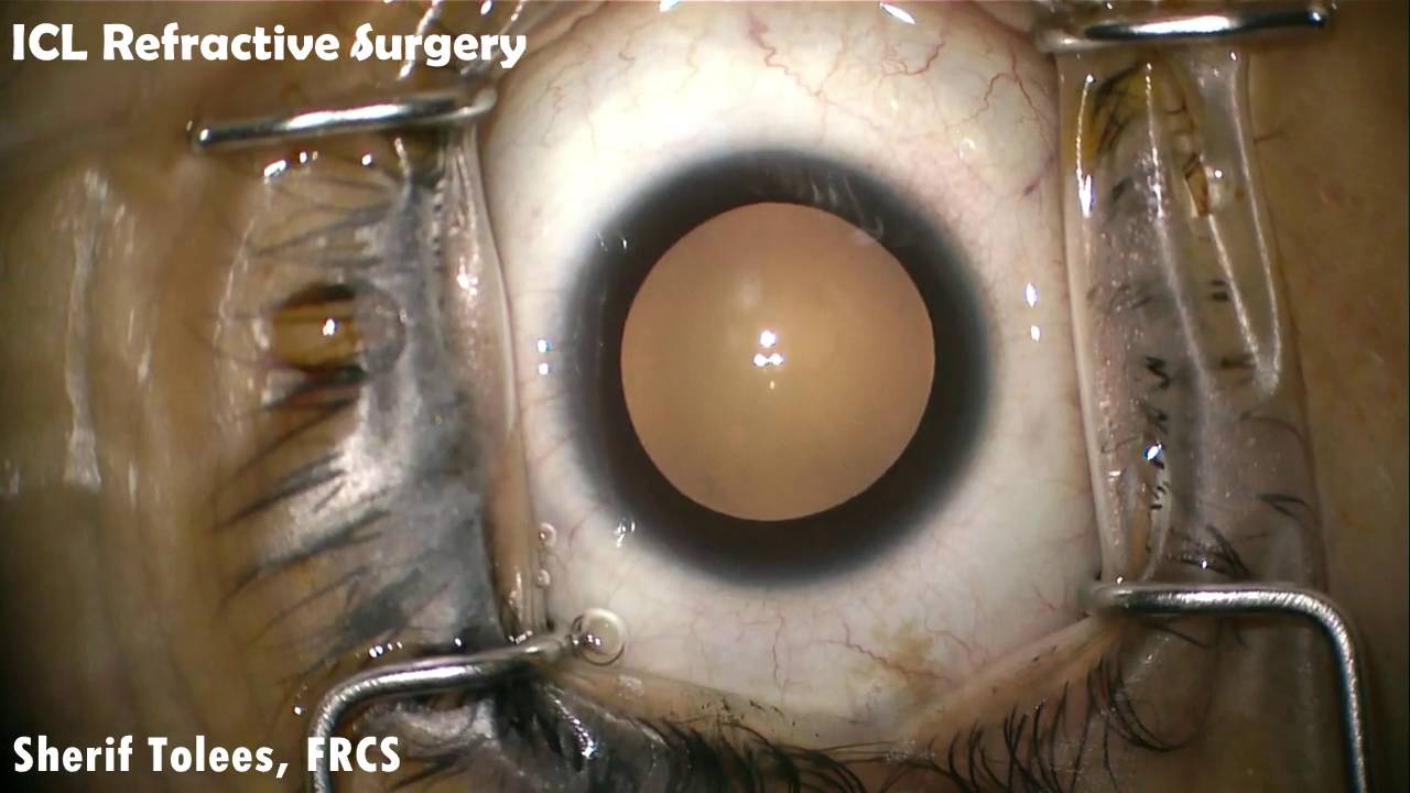 Myopic ICL Refractive Surgery - Sherif Tolees - YouTube