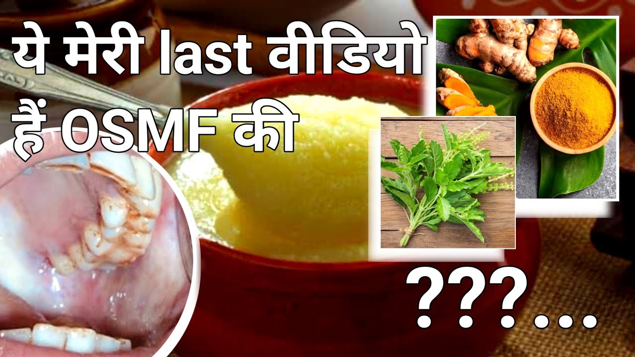 ये मेरी last vedio है OSMF की। submucous Fibrosis Treatment।osmf को ...