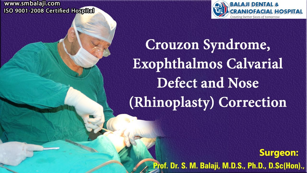 Crouzon Syndrome, Exophthalmos Calvarial Defect and Nose (Rhinoplasty ...