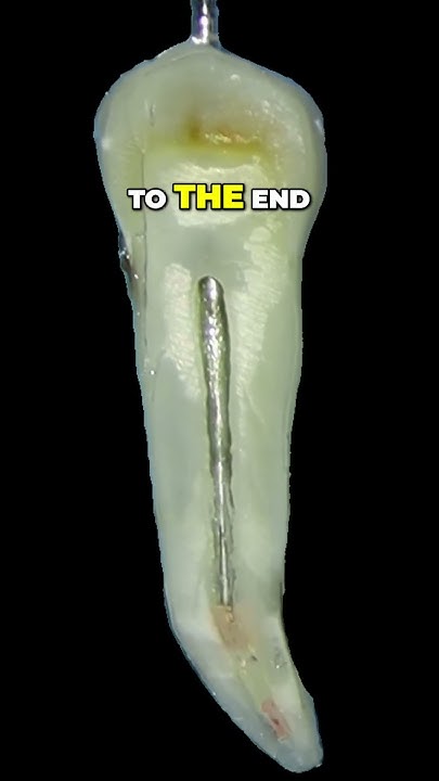 Mastering Root Canal Procedures Proper Backfilling Techniques - YouTube