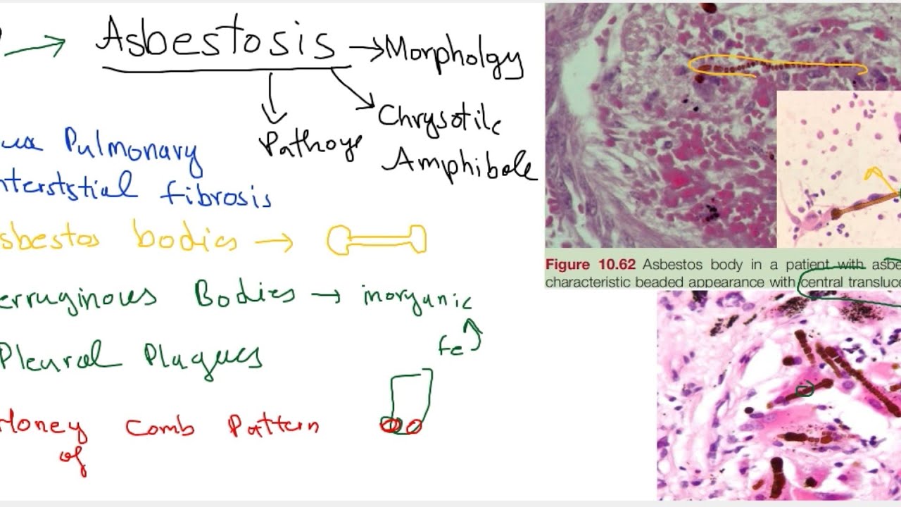 Asbestos Bodies Pathology