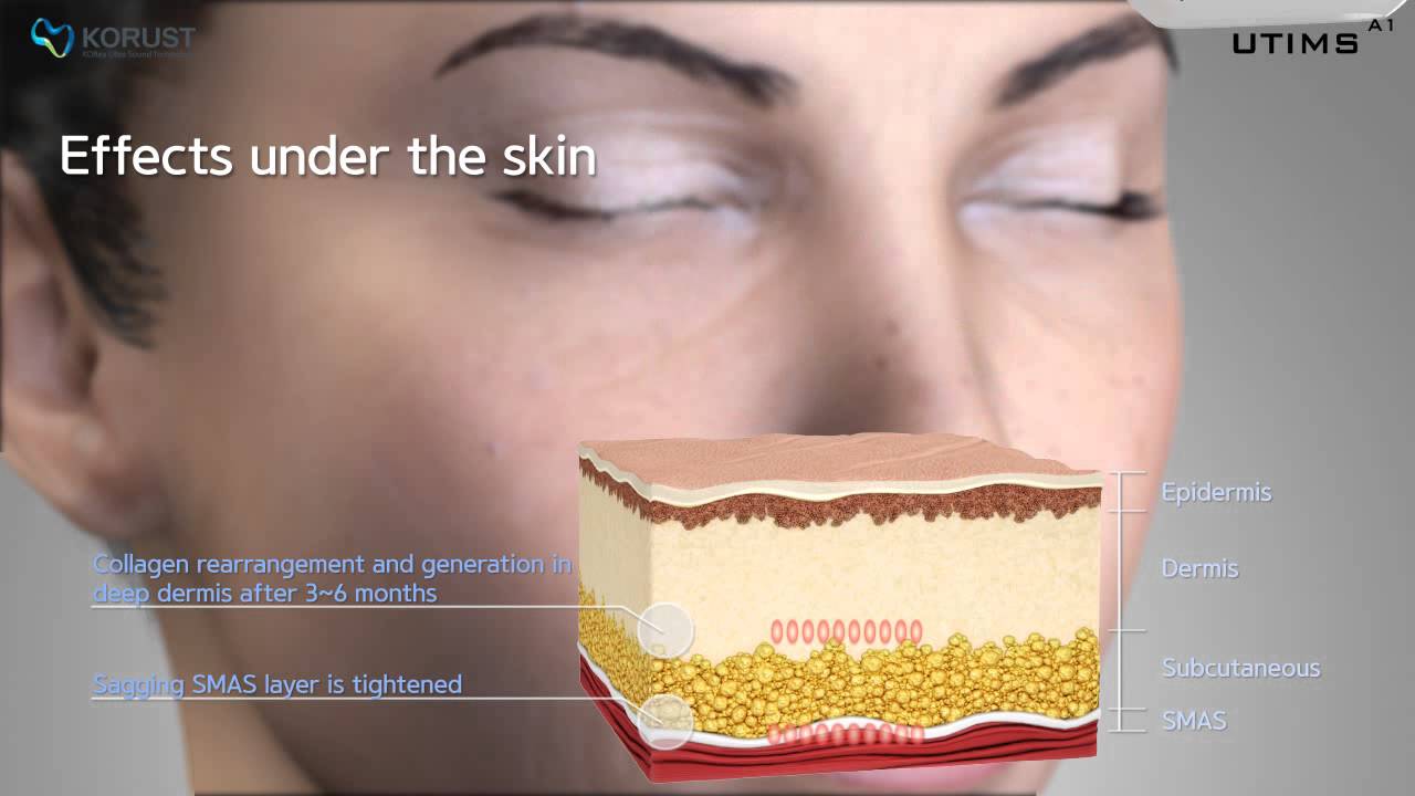 HIFU Treatment "UTIMS A1" - YouTube