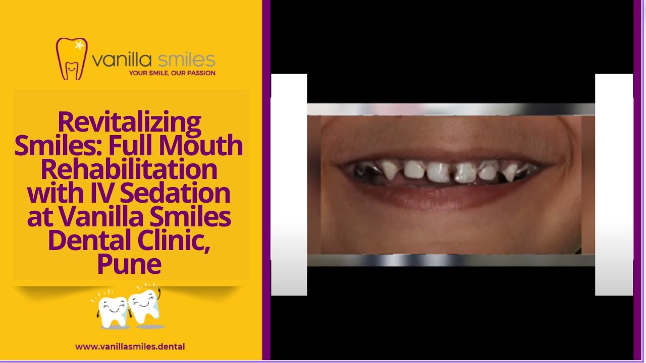 Revitalizing Smiles Full Mouth Rehabilitation with IV Sedation at ...