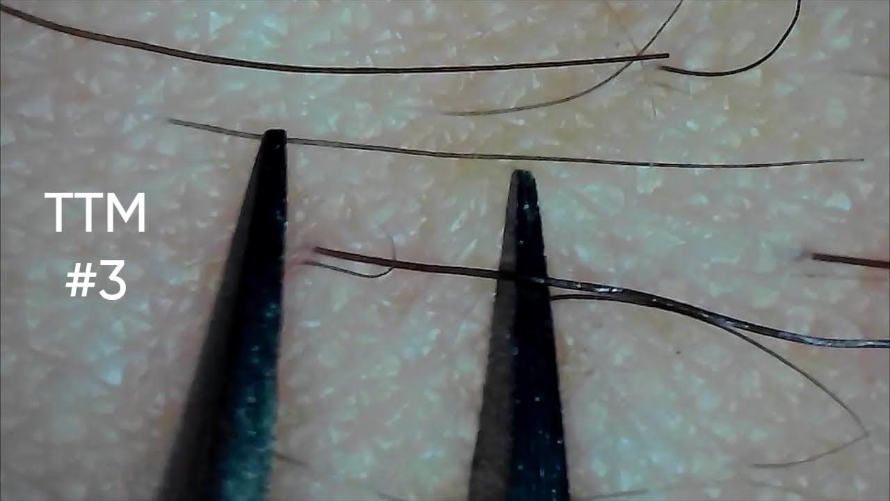 Let's Gently Tweeze & Pluck Hairs on the Arm | 50x Zoom Close-Up #3 ...