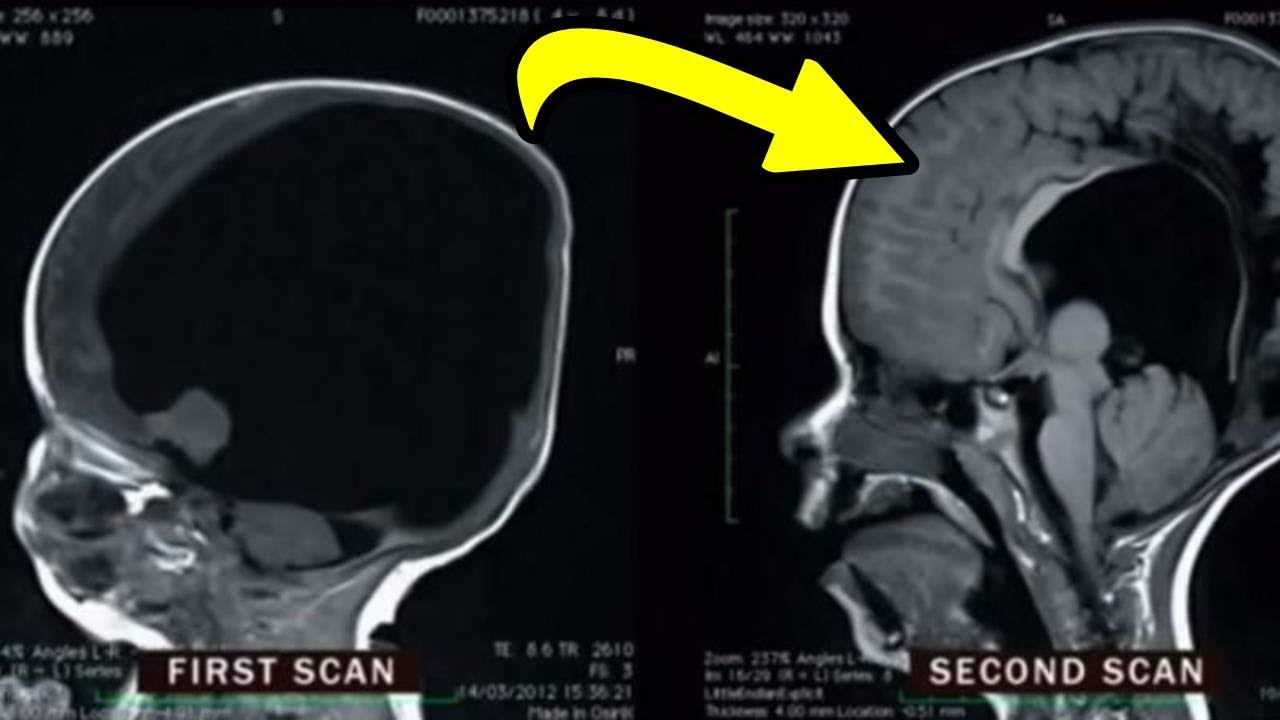 Boy Born With 2% Brain Grows The Rest On His Own - YouTube