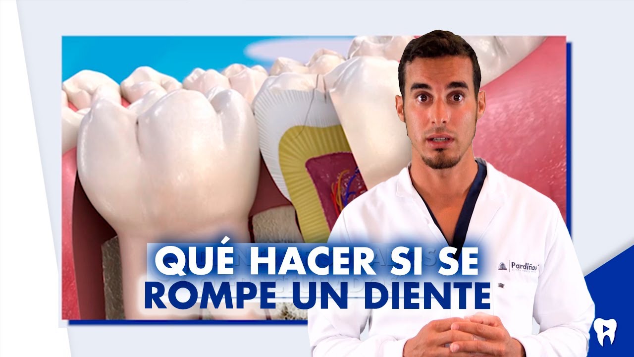 MUELA ROTA - Qué hacer si se rompe un diente y cómo evitarlo | #Shorts ...