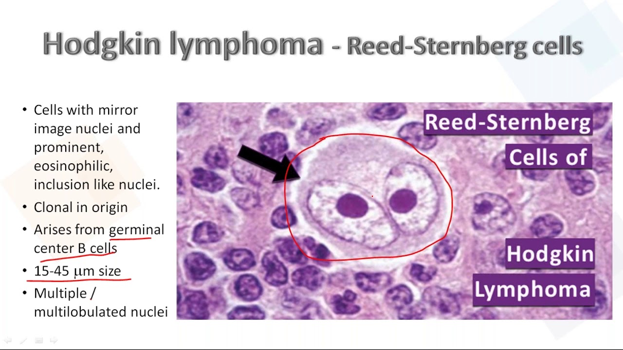 A Class On Pediatric Lymphomas By Dr Vittal, Dept Of Paediatrics - YouTube