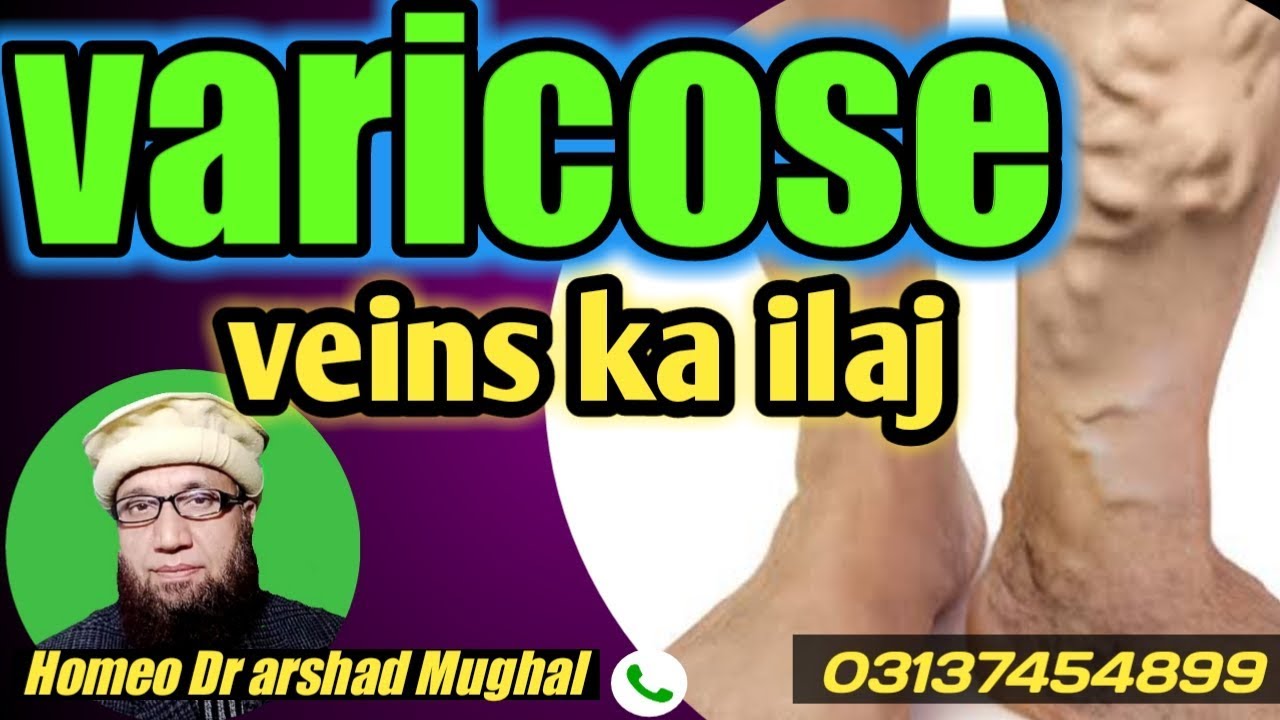 Latest Varicose Vein Treatment homeopathic Treatment Of Varicose Veins Latest Varicose Vein Treatment homeopathic Treatment Of Varicose Veins