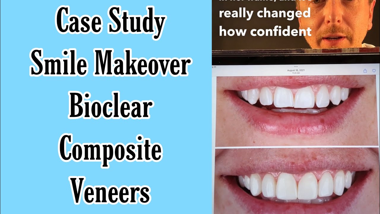 Bioclear Composite Veneers Smile Makeover - YouTube