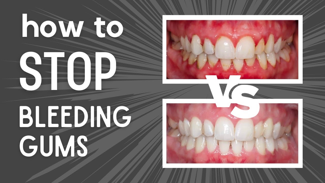 Bleeding Gums and How to Fix Them - YouTube