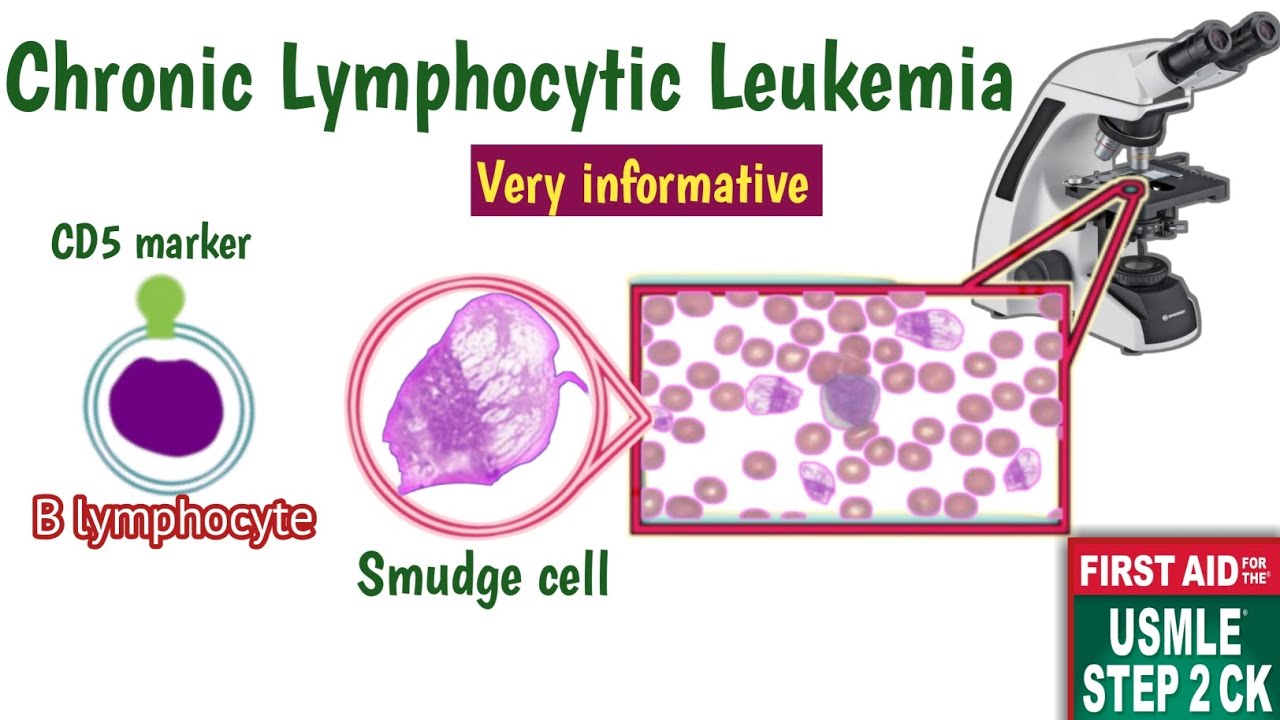 Chronic lymphocytic leukemia(CLL) |sign and symptoms of CLL | Diagnosis ...