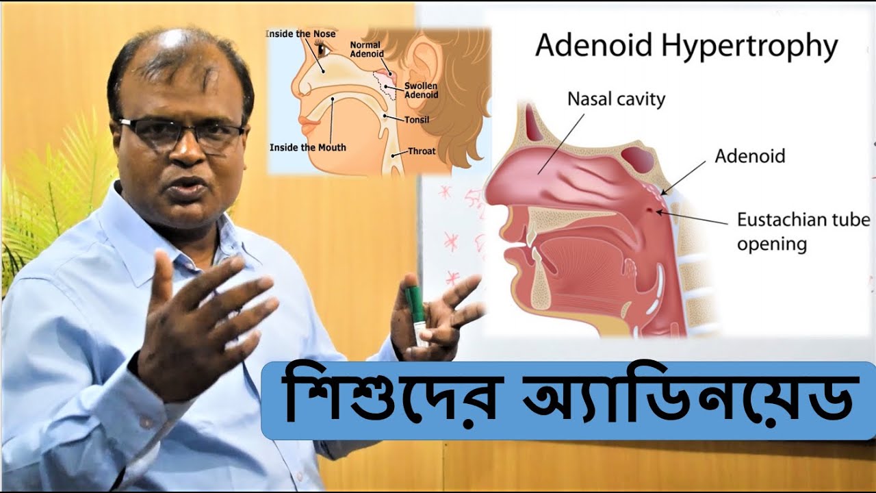 শিশুদের অ্যাডিনয়েড এর চিকিৎসা ও প্রতিকার | Treatment of adenoids in ...