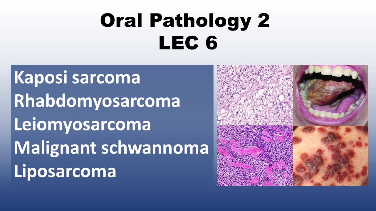 Oral Pathology 2 - LEC 6 - (Kaposi sarcoma - Rhabdomyosarcoma - Leiomyosarcoma) - YouTube