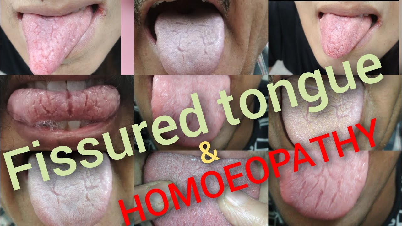 Cracks And Fissures On Tongue 👅 🩺dr Sandeep Sairal Youtube