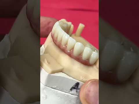 All-On-4 Zirconia with no Ti-Base @EnvisiontecMain #envisiontec