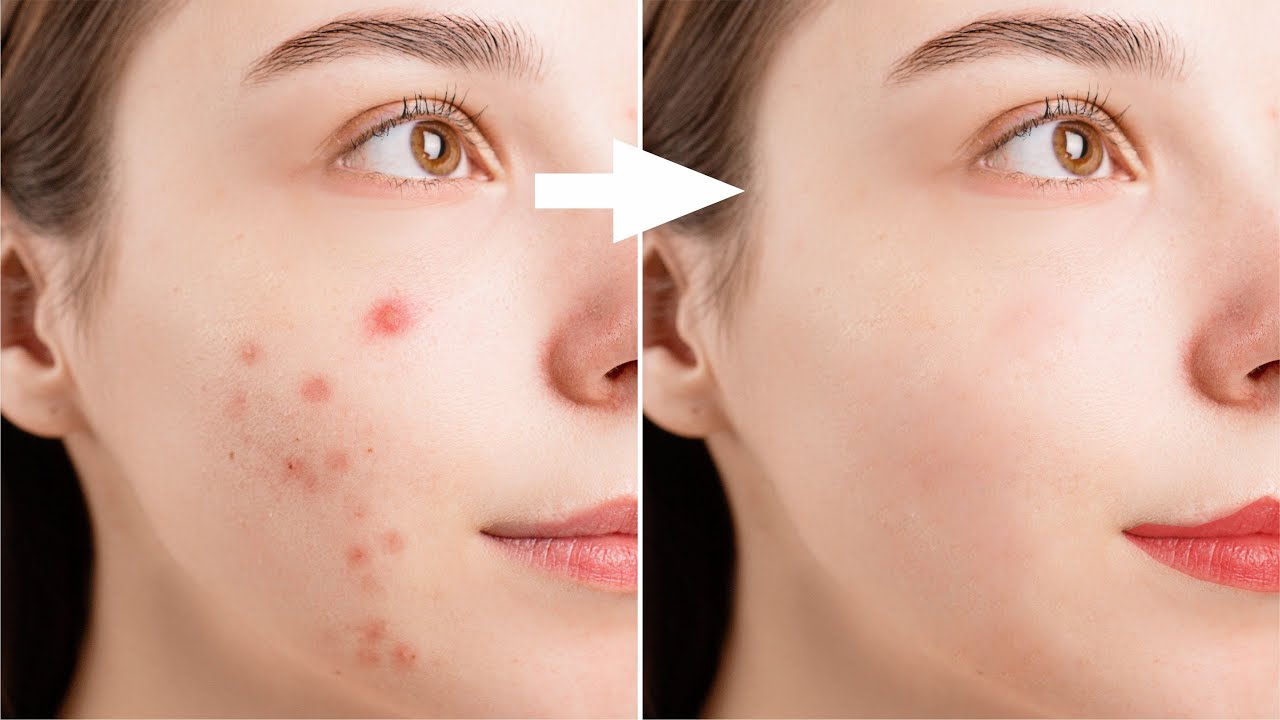 How to Remove Acne in Photoshop _ Remove pimples (fast and easy) - YouTube