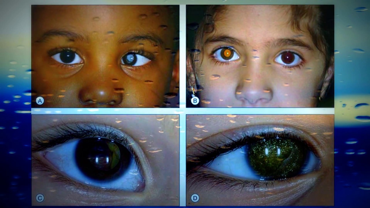 Asorliz Aviles Norrie Disease - YouTube