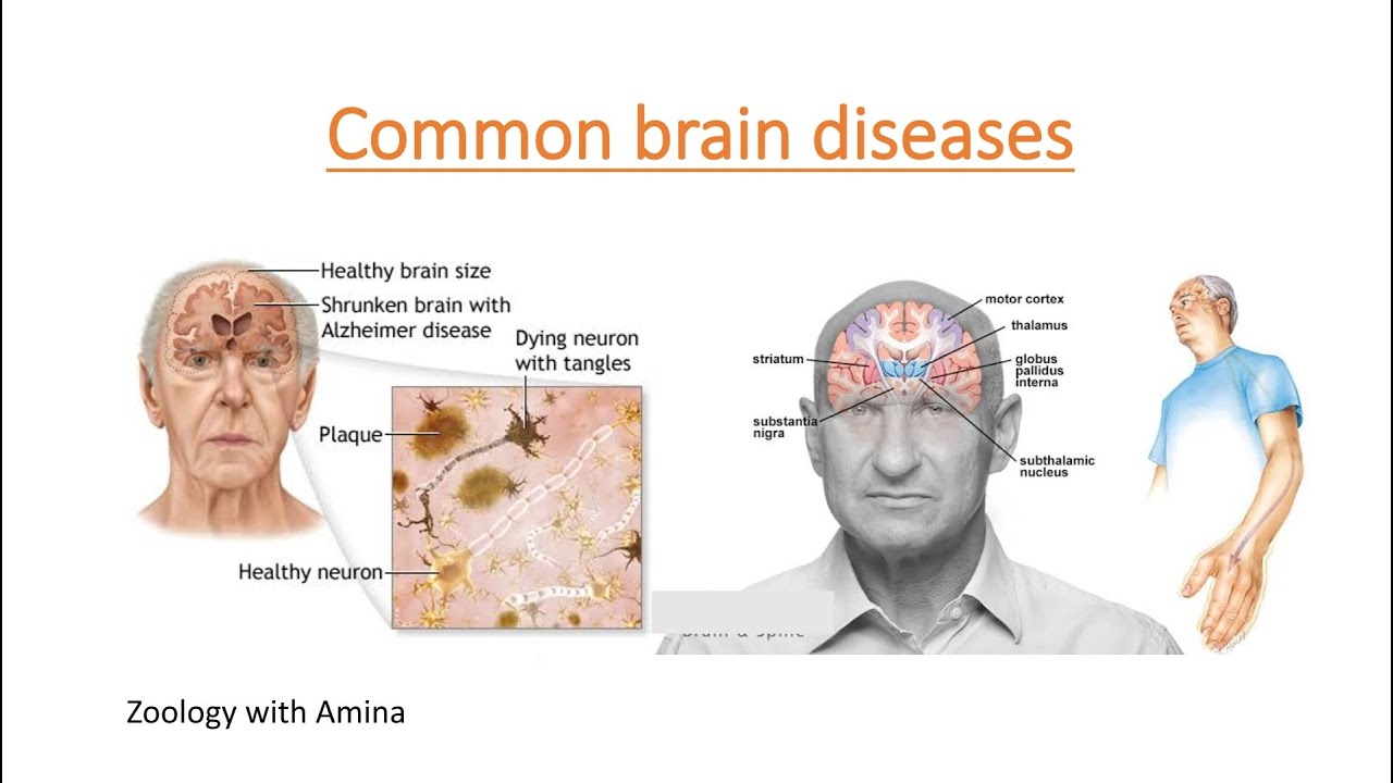 Common brain diseases and their causes | Nervous disorders - YouTube
