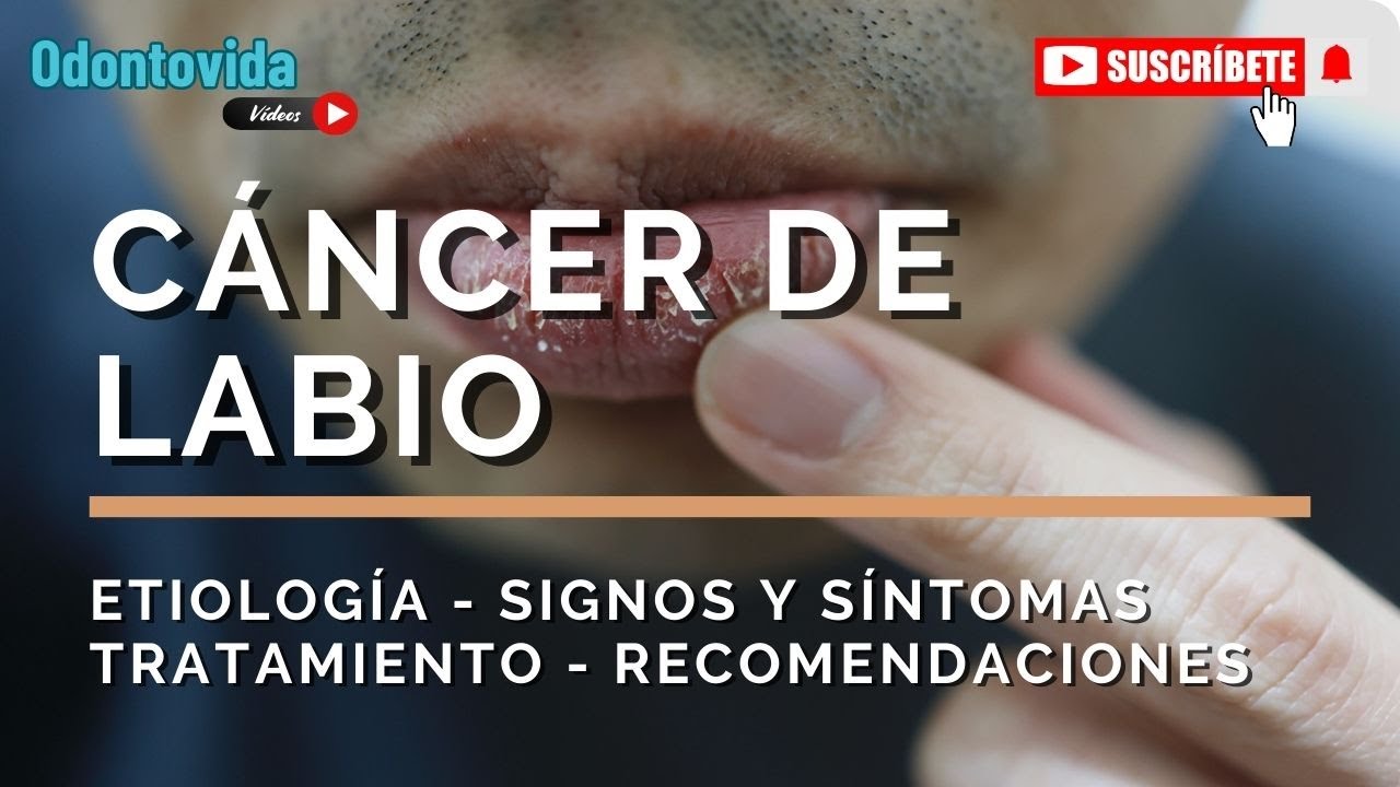 Cáncer de Labio. Todo lo que necesitas saber - YouTube