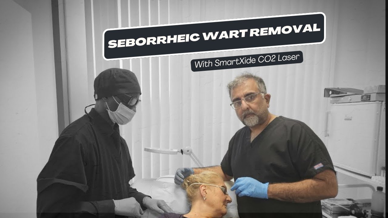 Transforming Wart Removal with SmartXide CO2 Laser - YouTube