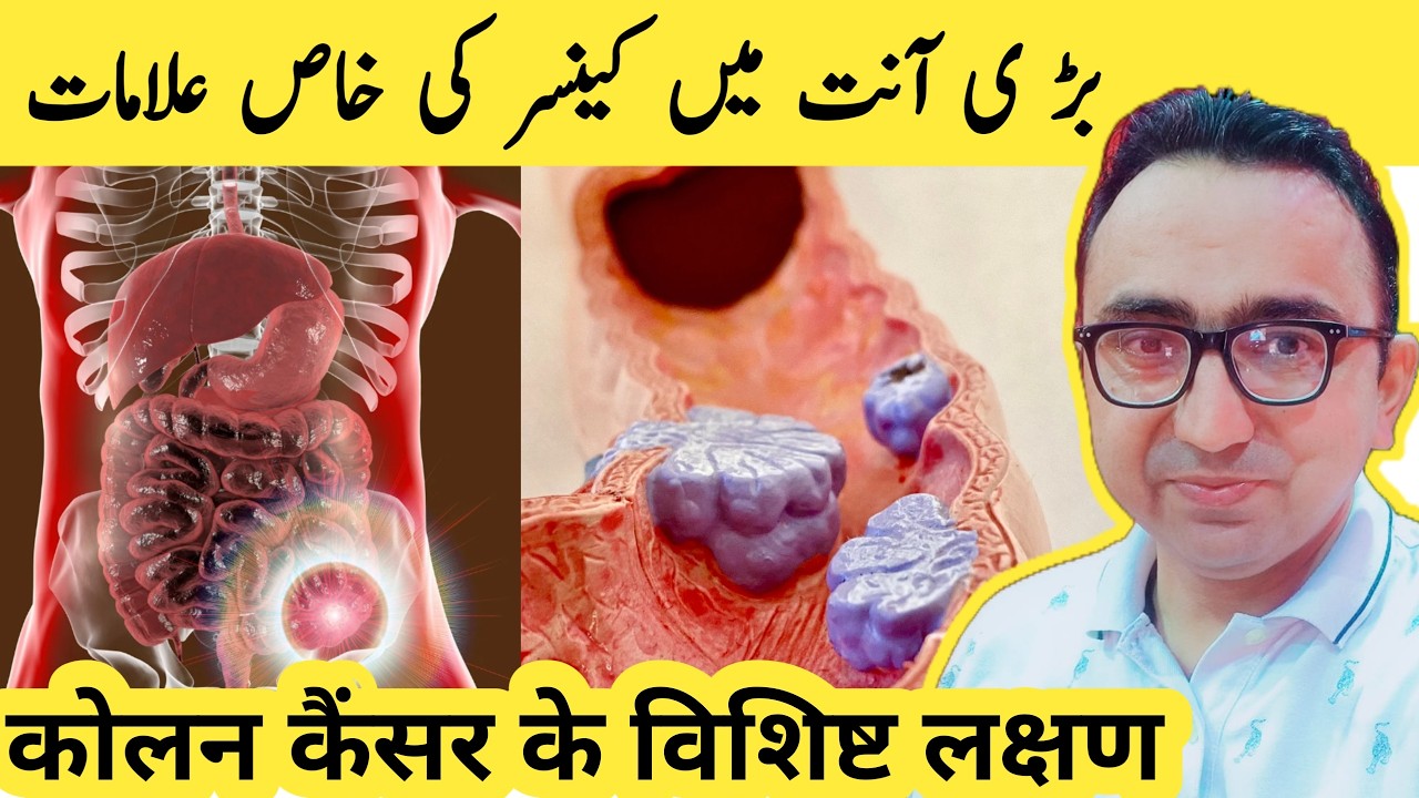 5 Warning Signs of Colon Cancer You Should Never Ignore - YouTube