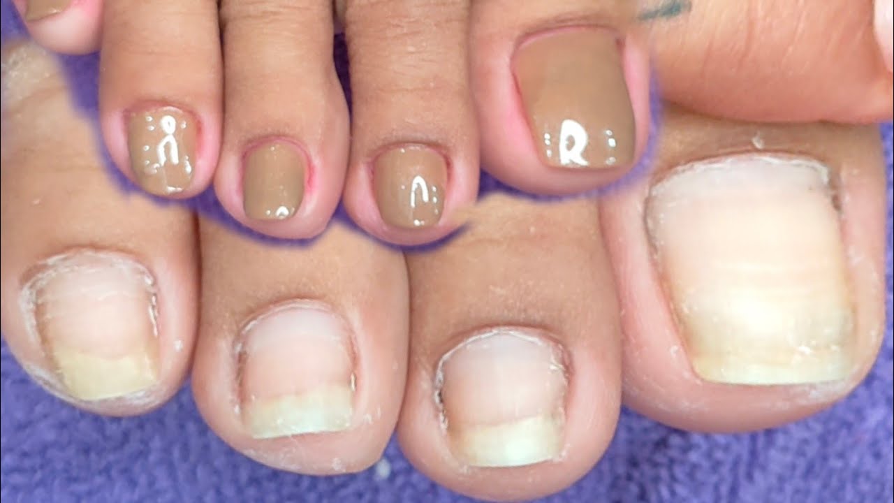 part2 Full of dry skin and Ingrown (But Beautiful Nail with Nail polish ...