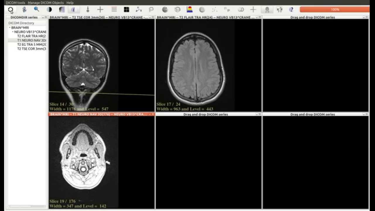 Simple DICOM image tools in JimboDICOMViewer - YouTube