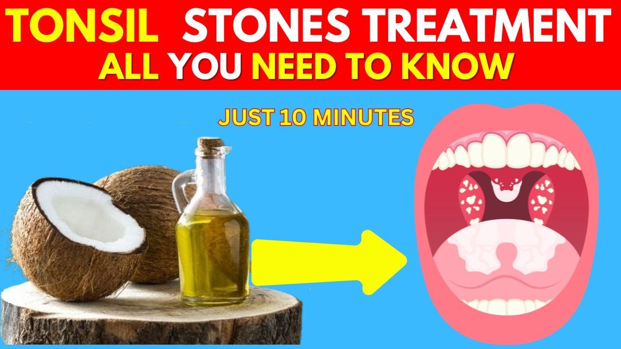 Remove Tonsil Stones 10 Powerful Home Remedies for Tonsil Stones Relief ...
