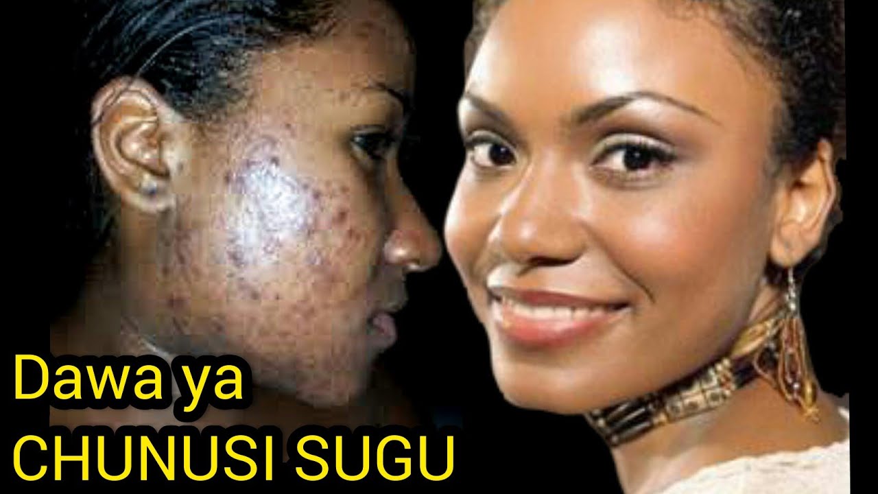 DAWA YA CHUNUSI SUGU | Sababu za chunusi | Acne causes and treatment ...