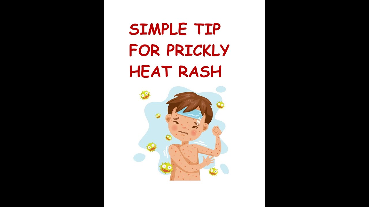 PRICKLY HEAT RASH - HOME REMEDIES - YouTube