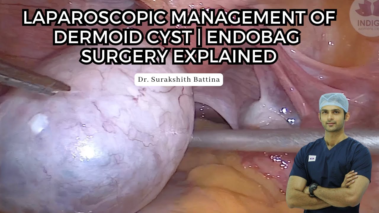 Laparoscopic Dermoid Cyst Excision | ENdobag | Surgery Explanation | Dr ...