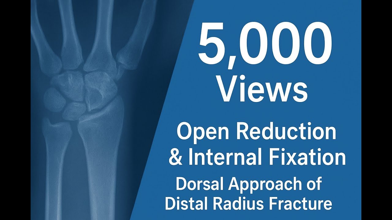 Dorsal Approach and Plating of a Distal Radius Fracture( step by step ...