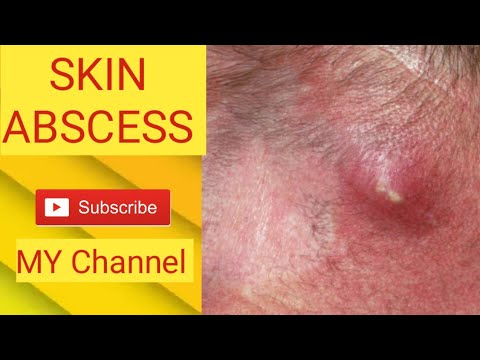 SKIN ABSCESS - YouTube