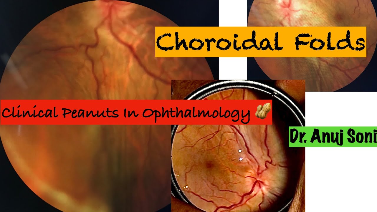 Choroidal folds - Idiopathic Choroidal folds Vs Compressive Choroidal ...